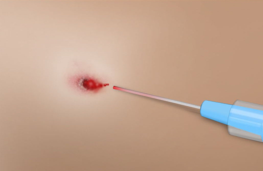 Clik-FIX Catheter Securement Devices - B. Braun