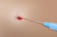 Clik-FIX Catheter Securement Devices - B. Braun