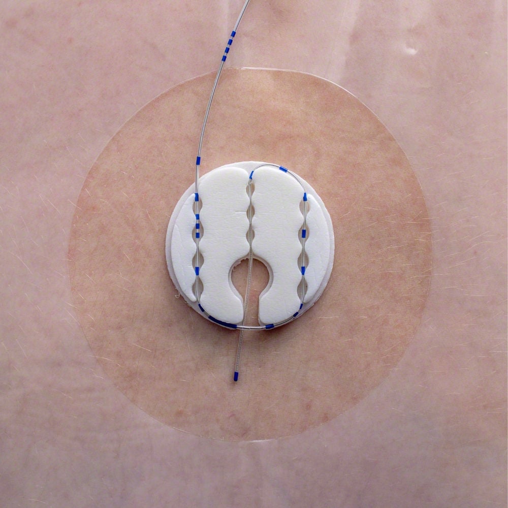 Clik-FIX® Family of Catheter Securement Devices for Regional Anesthesia