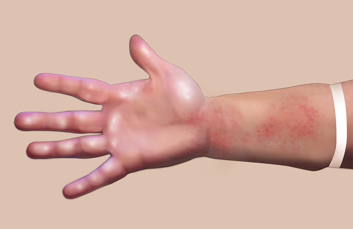 Clik-FIX Catheter Securement Devices - B. Braun