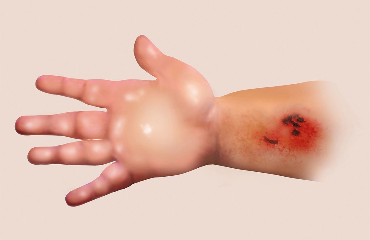 Clik-FIX Catheter Securement Devices - B. Braun