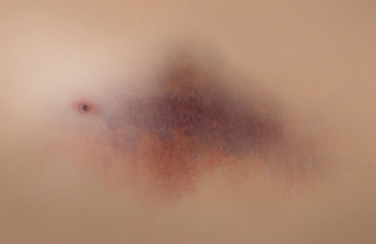 Clik-FIX Catheter Securement Devices - B. Braun