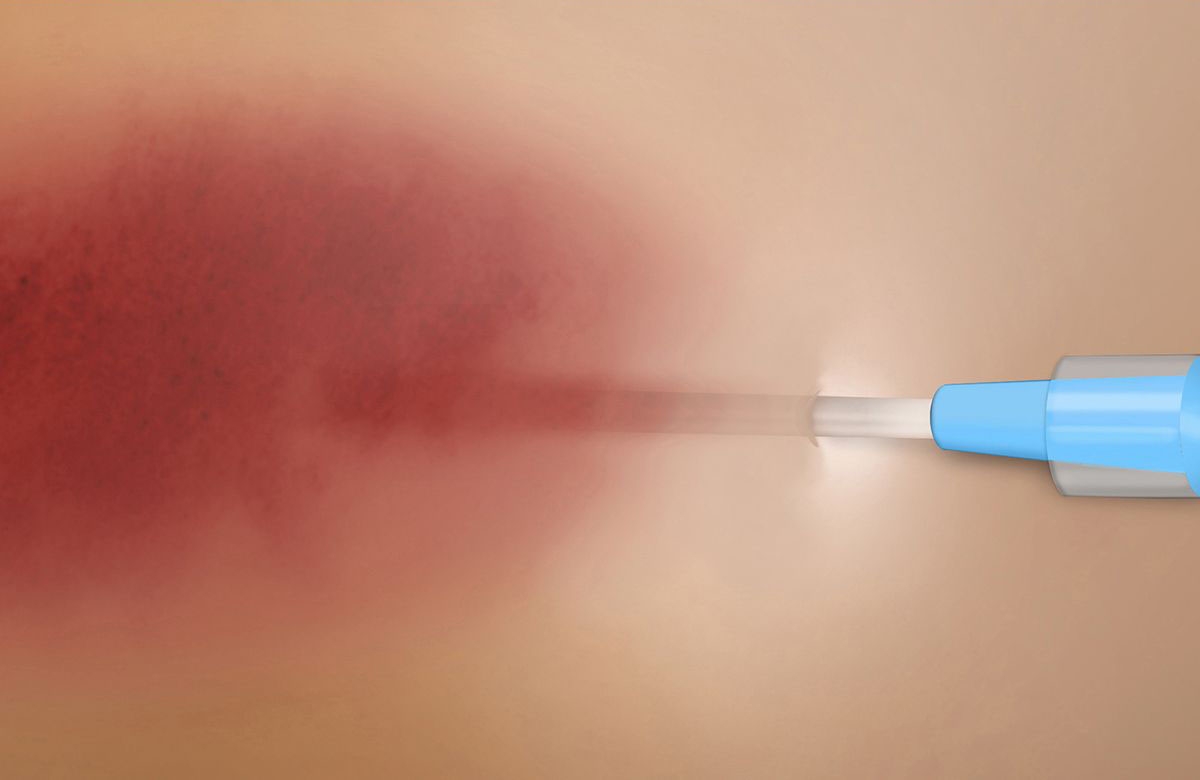 Clik-FIX Catheter Securement Devices - B. Braun